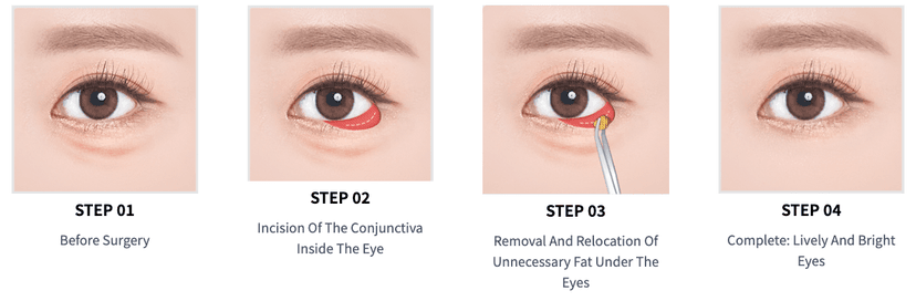 Under Eye Fat Grafting in Korea | Best Clinics, Costs, Procedure Types ...