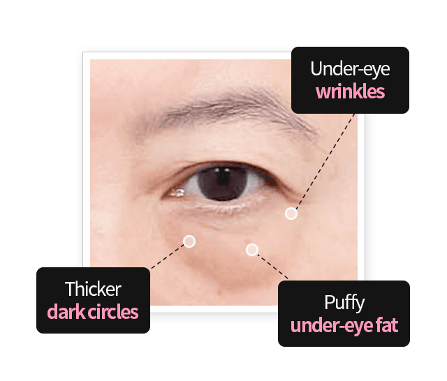 Effective Hemifacial Spasm Treatment with Blepharoplasty in Korea ...
