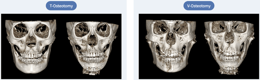 Discover the True Cost of V Line Surgery: Korea vs Global Destinations ...