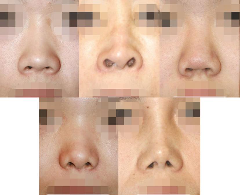 Alar Reduction in Korea: Fixing Nostril Flaring When Smiling