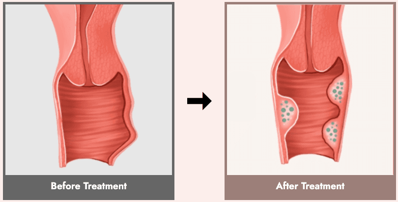Vaginal Filler in Korea | Best Clinics, Costs, Procedure Types & More