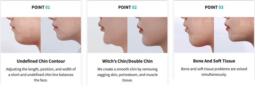 Chin Surgery in Korea | Best Clinics, Costs, Procedure Types & More