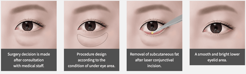 Puffy Eyes Treatment in Korea: Under Eye Fat Removal, Blepharoplasty ...