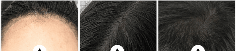 Hairline Microblading in Korea | Best Clinics, Costs, Procedure Types ...