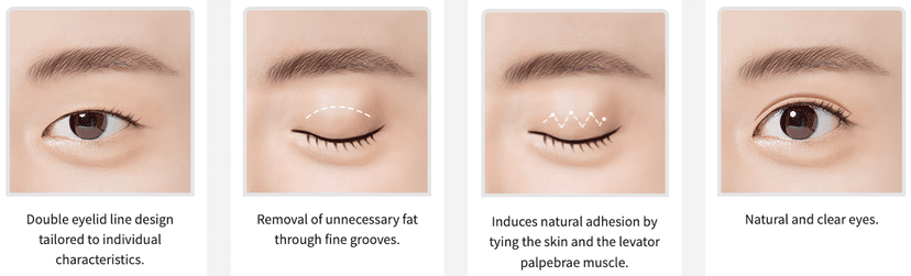 Double Eyelid Surgery in Korea | Best Clinics, Costs, Procedure Types ...